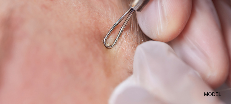 Dermojet Injection Uses: A Comprehensive Guide to Dermatology Treatment ...